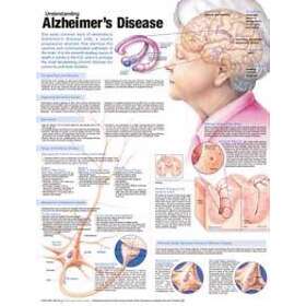 Understanding Alzheimer's Disease Anatomical Chart - Hitta bästa pris ...